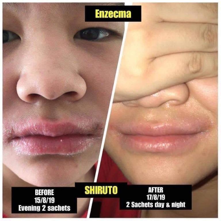 Shiruto 免疫維生素 改善濕疹#皮膚敏感#改善免疫力, 兒童＆孕婦用品, 餵養產品 & 奶粉 - Carousell