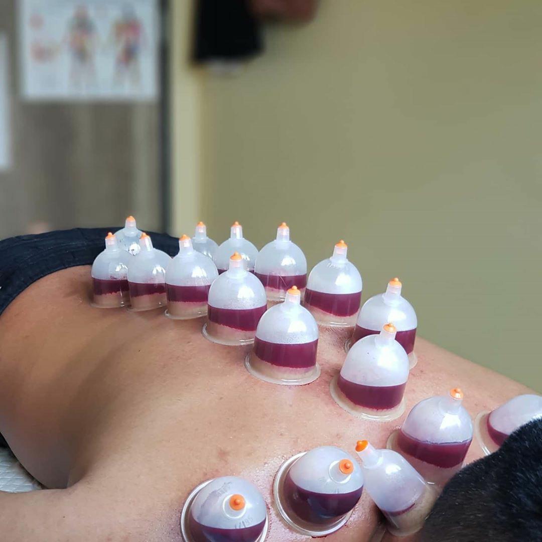 Bekam/ cupping therapy, Lifestyle Services, Beauty & Health Services on ...