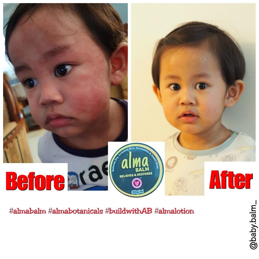 Eczema Cream Beauty And Personal Care Bath And Body Body Care On Carousell