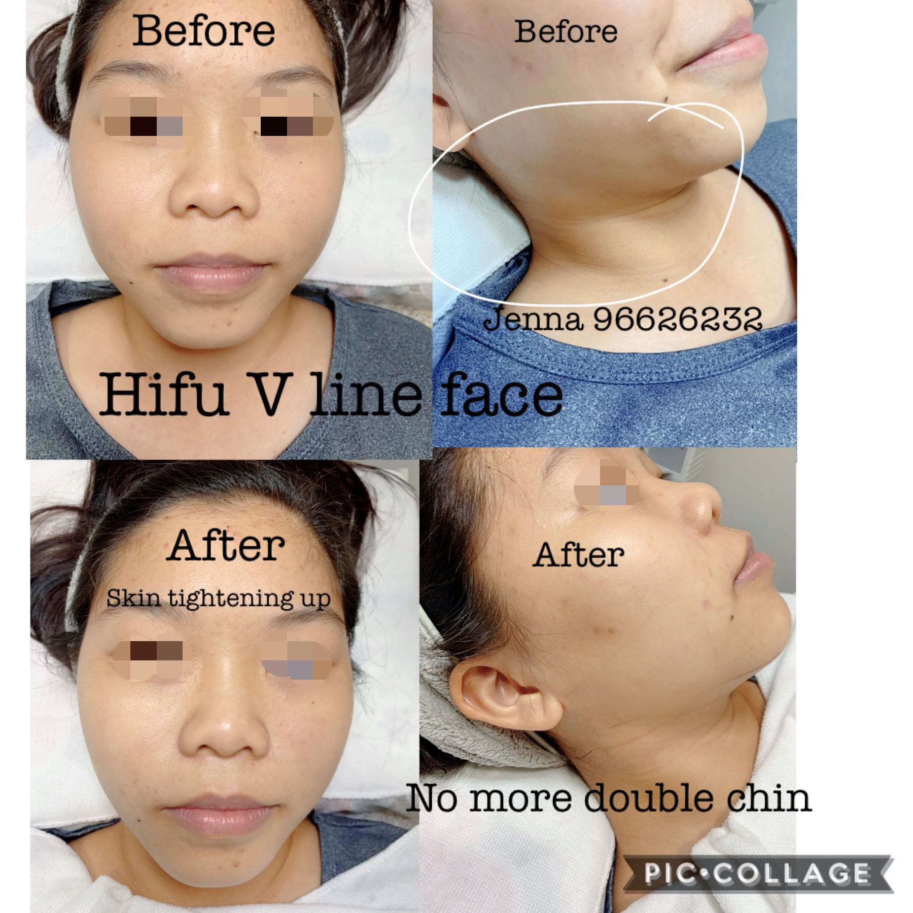 Hifu V line Face, Beauty & Personal Care, Face, Makeup on Carousell