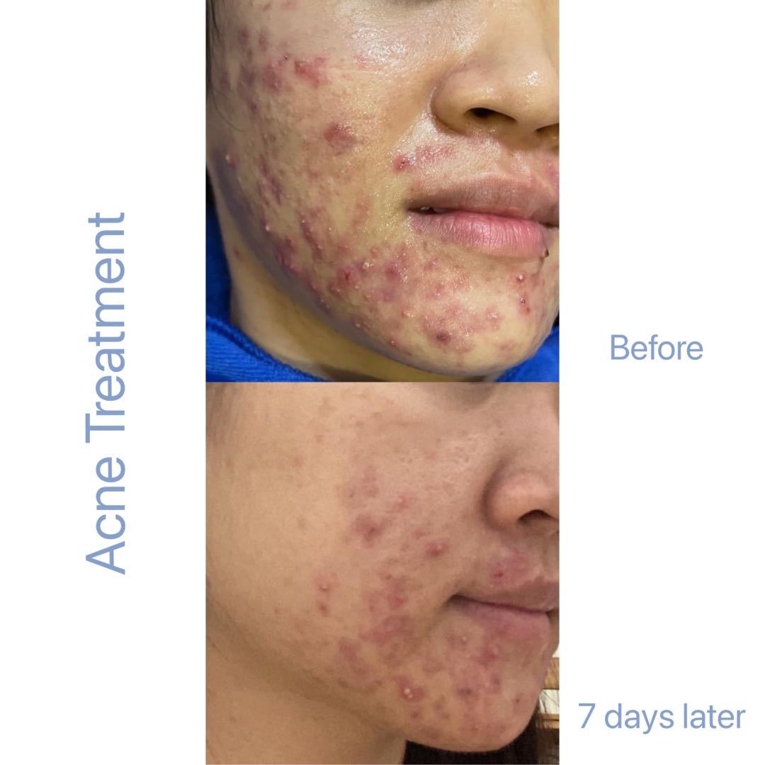 Cold (CRYO) plasma treatment for serious inflammation, acne marks, anti ...