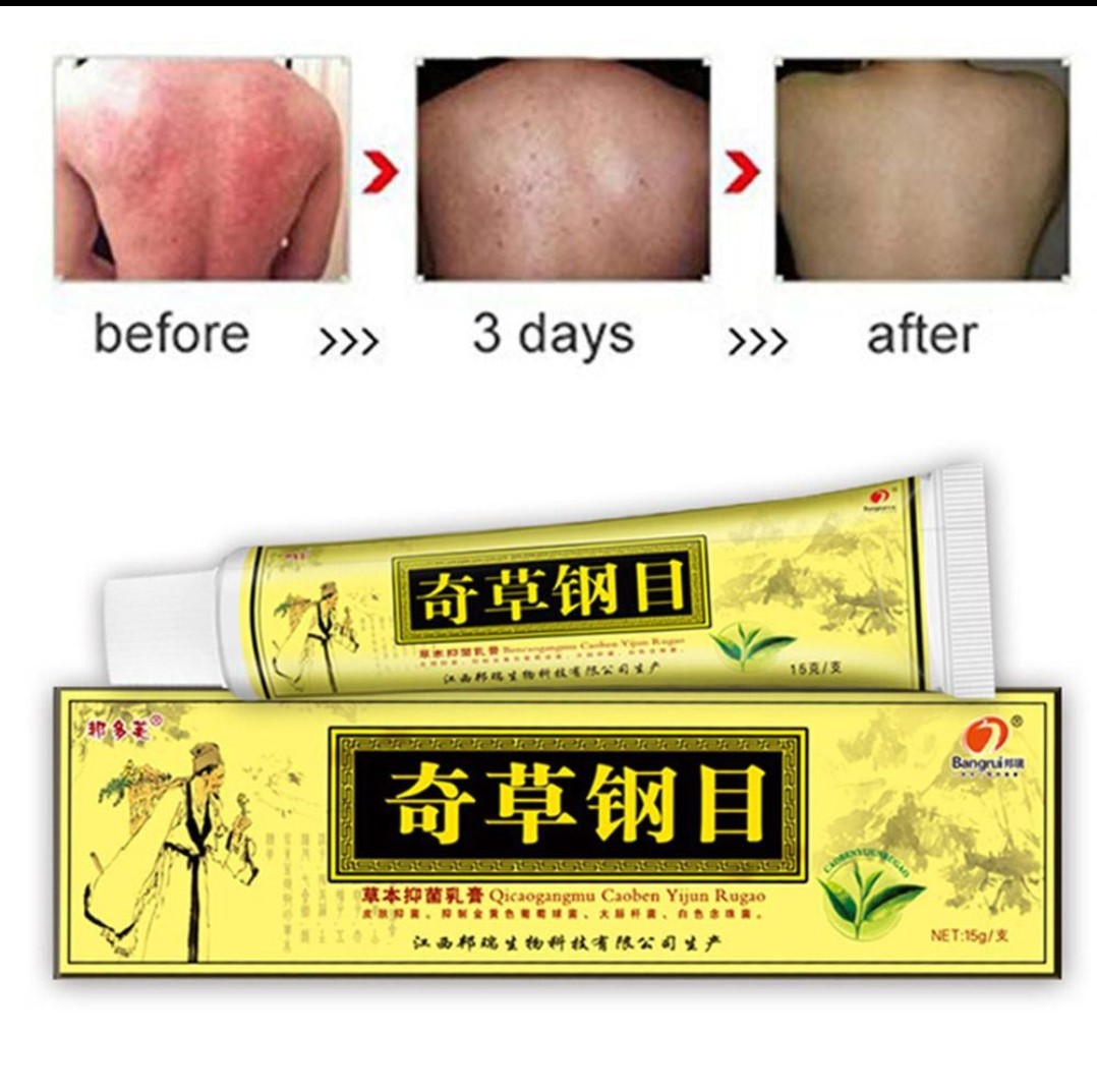 Chinese Herbal Eczema Psoriasis Creams Dermatitis And Eczema. Psoriasis ...