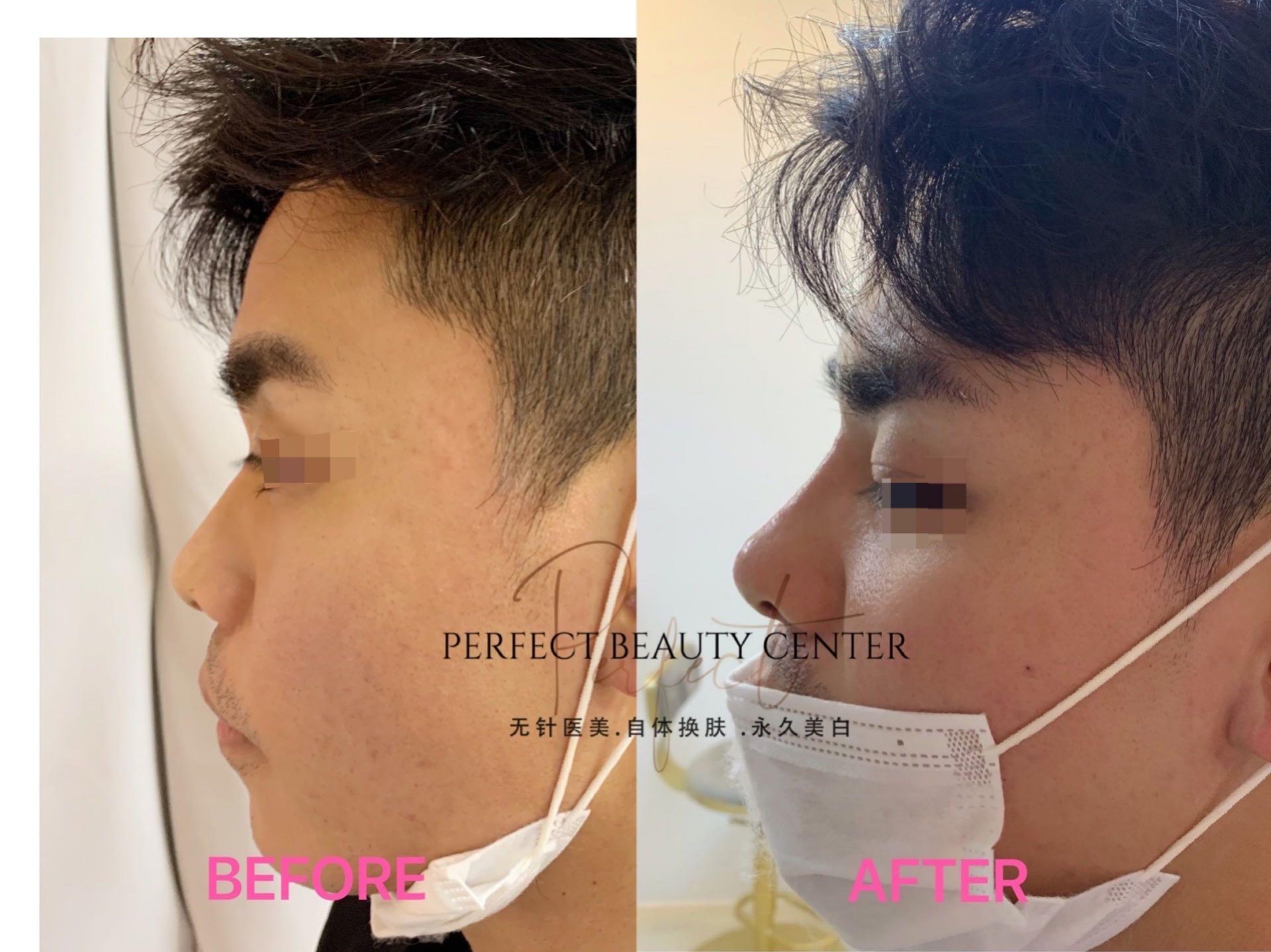 Nose Bridge, Nose Tips, Lips, Chin, Temple, Forehead, Under Eye ...