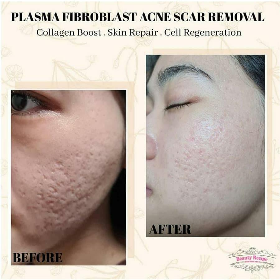 Non Surgical Lip Shaping, Upper Eyelid Lift, Eye Wrinkle Removal, Acne ...