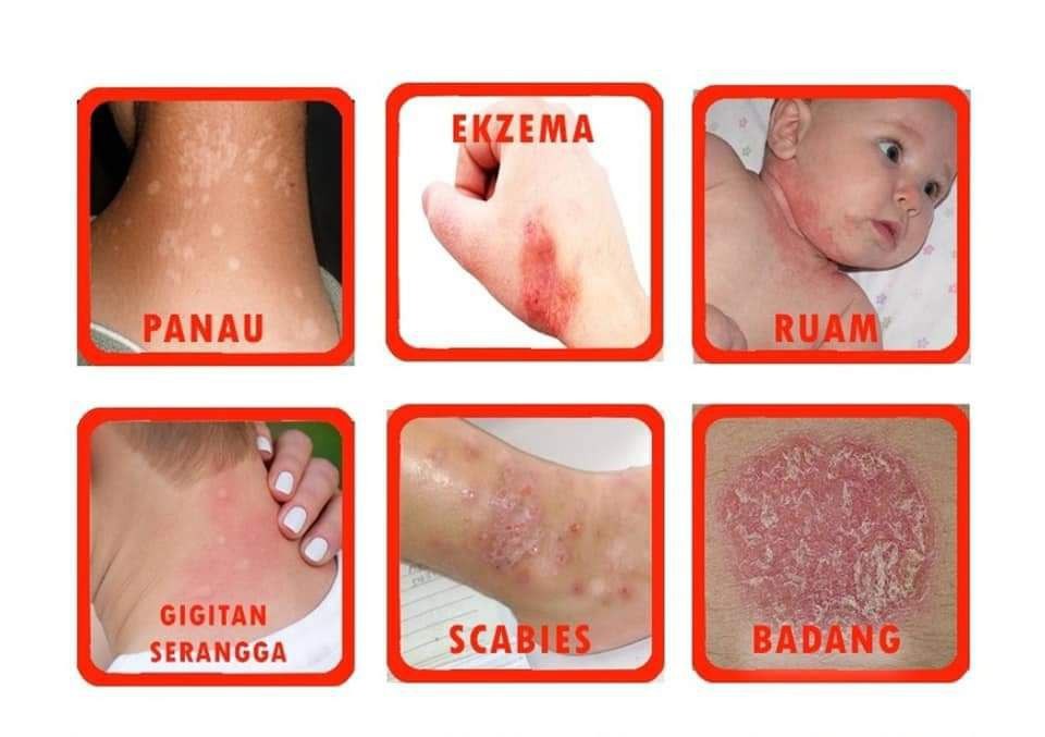 Gamat cream, Beauty & Personal Care, Bath & Body, Body Care on Carousell