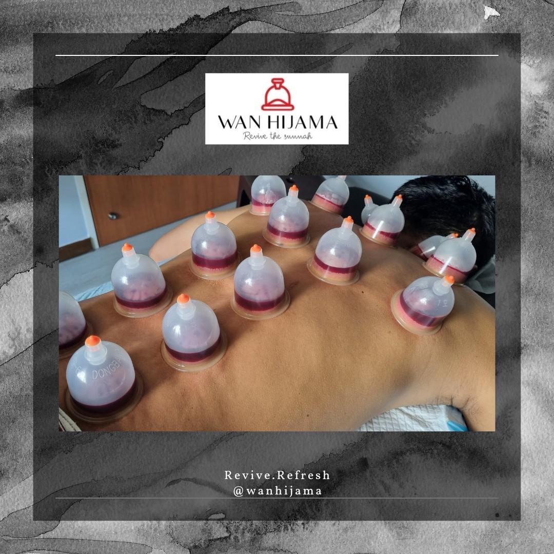 Hijama / bekam / wet cuppings, Announcements on Carousell