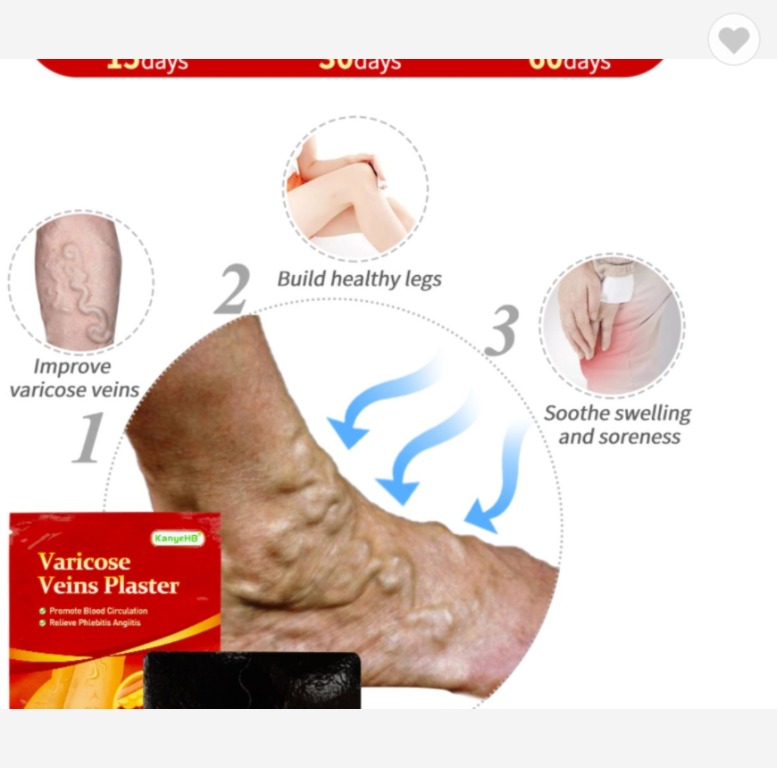 Varicose Veins Plaster (10 pcs/pack), Beauty & Personal Care, Foot Care ...