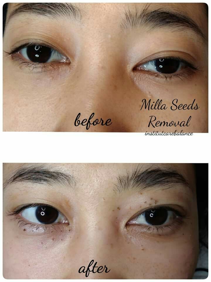 Millia Seed, Beauty & Personal Care, Face, Face Care on Carousell