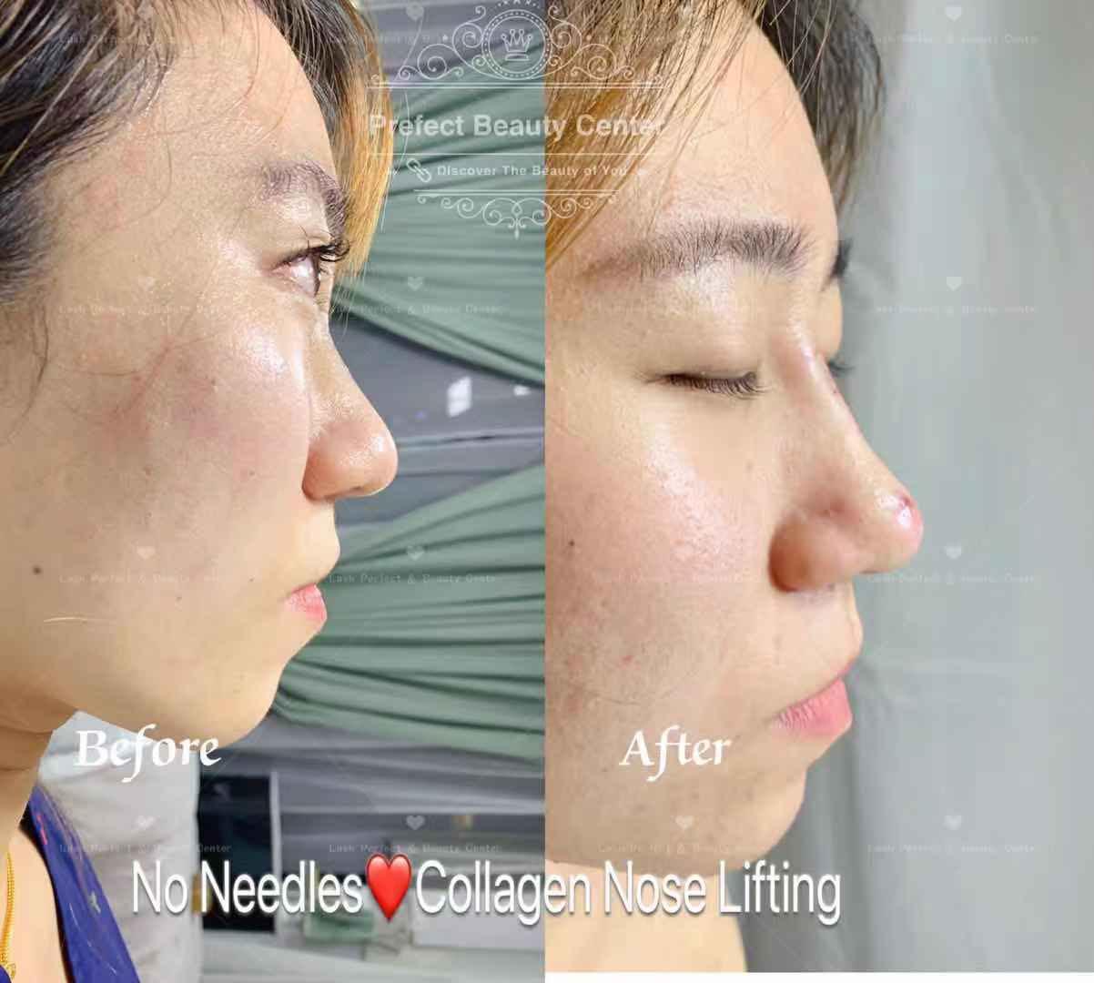 Nose Bridge, Nose Tips, Lips, Chin, Temple, Forehead, Under Eye ...