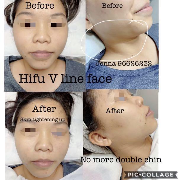 Vline face without injection, Lifestyle Services, Beauty & Health ...