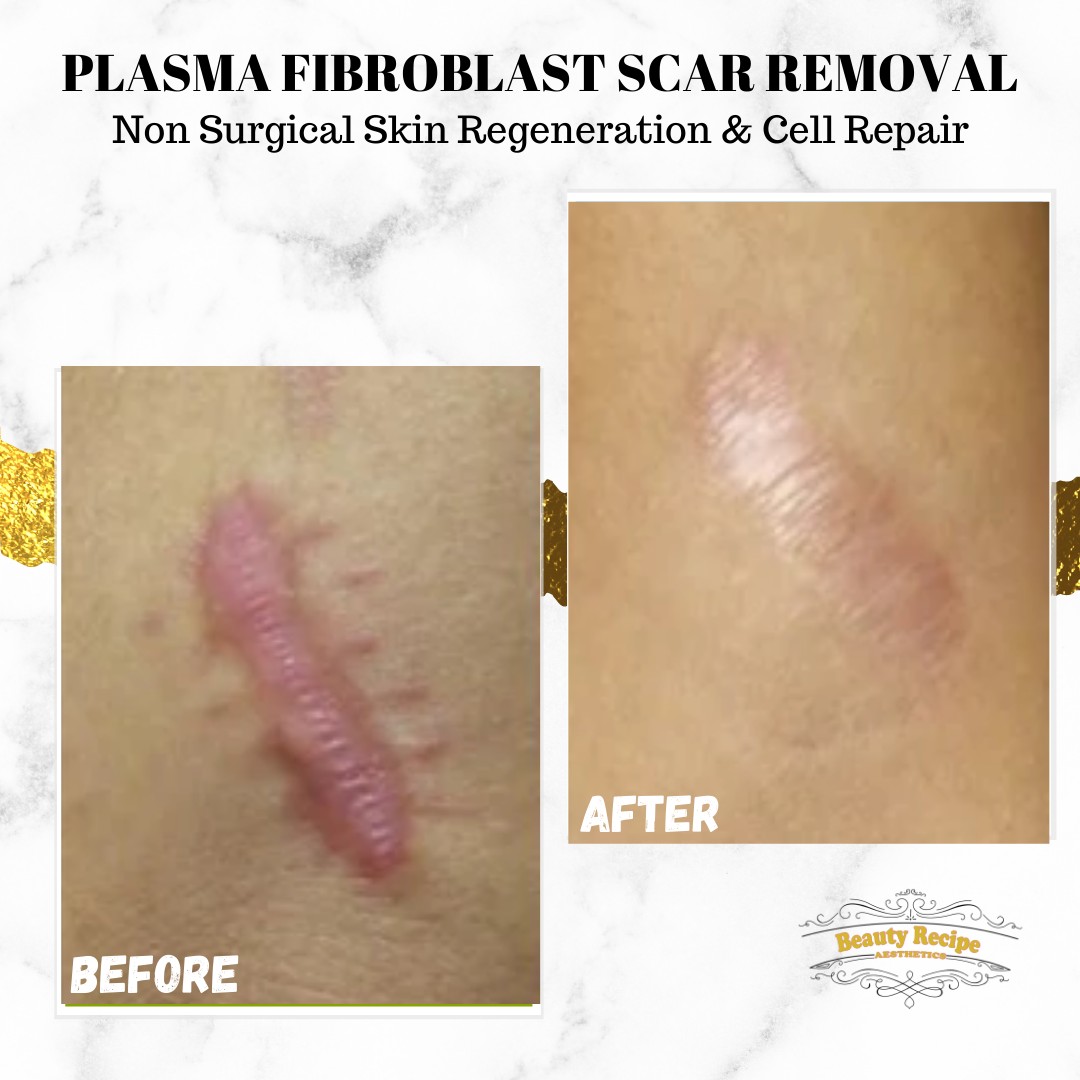 Surgical Body Scar Treatment By Plasma Fibroblasts, Beauty & Personal ...