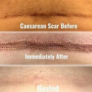 Caesarean Surgical Scar Removal By Plasma Fibroblasts, Beauty ...