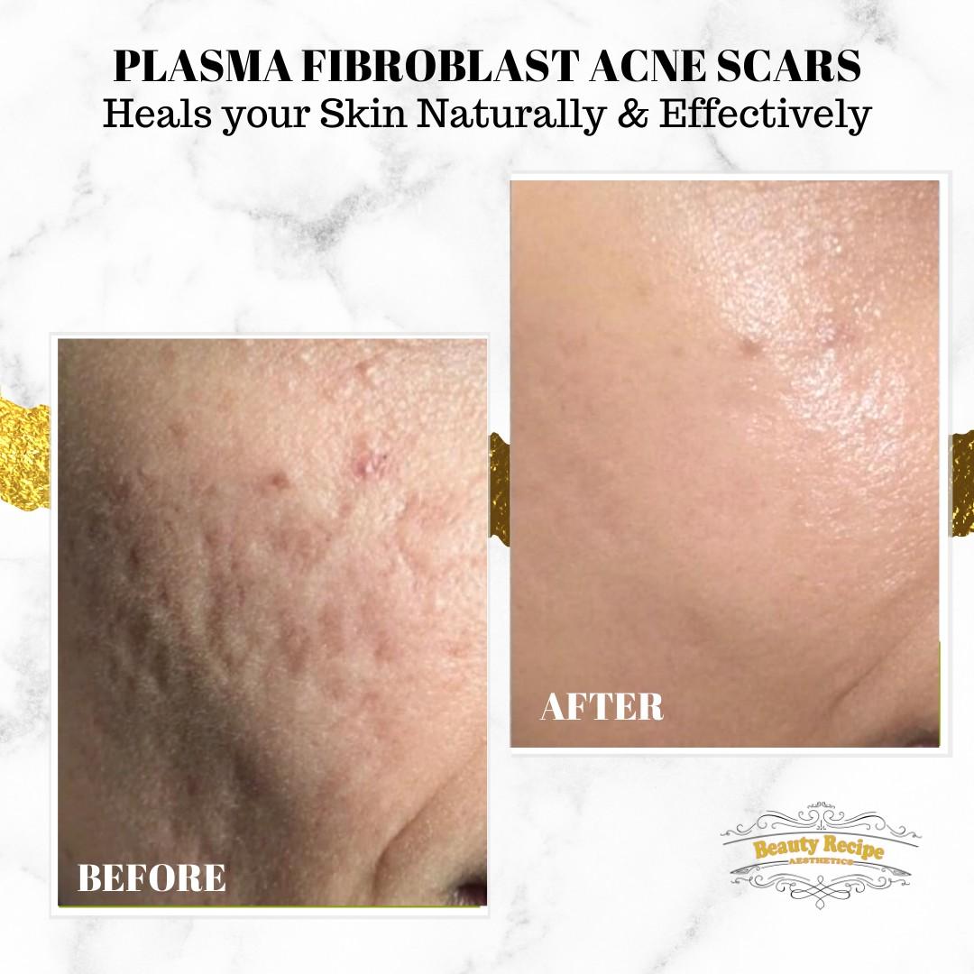 Acne Scars or Surgical Scar Removal By Plasma Fibroblast Treatment ...