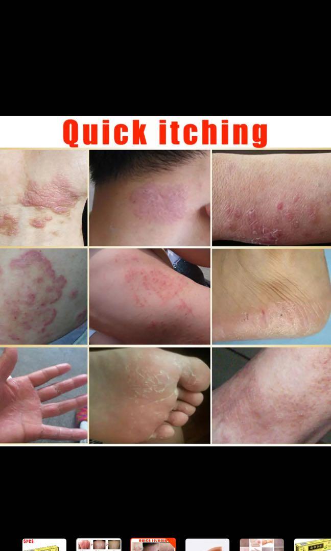 Skin Problem Solution-Psoriasis Ezcema tinea capitis Itch Fungal ...