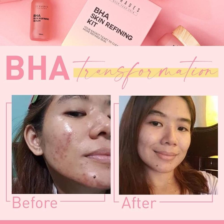 SCHADES BHA SKIN REFINING KIT -Acne Treatment / For Pimples/ Dark Spots ...