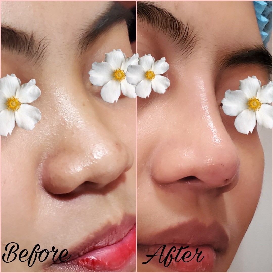 HIKO NON SURGICAL NOSELIFT, Beauty & Personal Care, Face, Face Care on ...