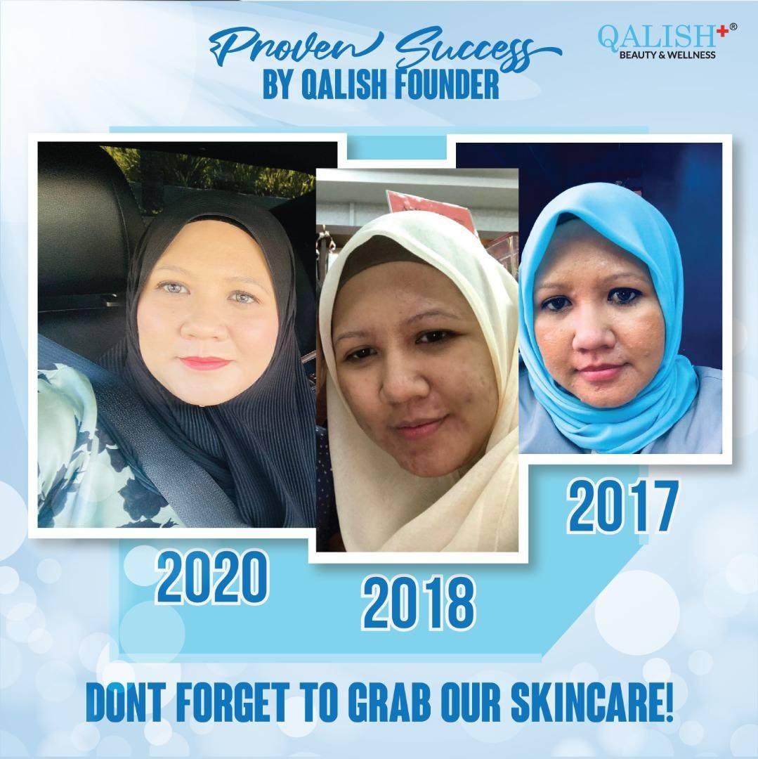PROFIX ACNE TREATMENT BALM, Beauty & Personal Care, Face, Face Care on ...