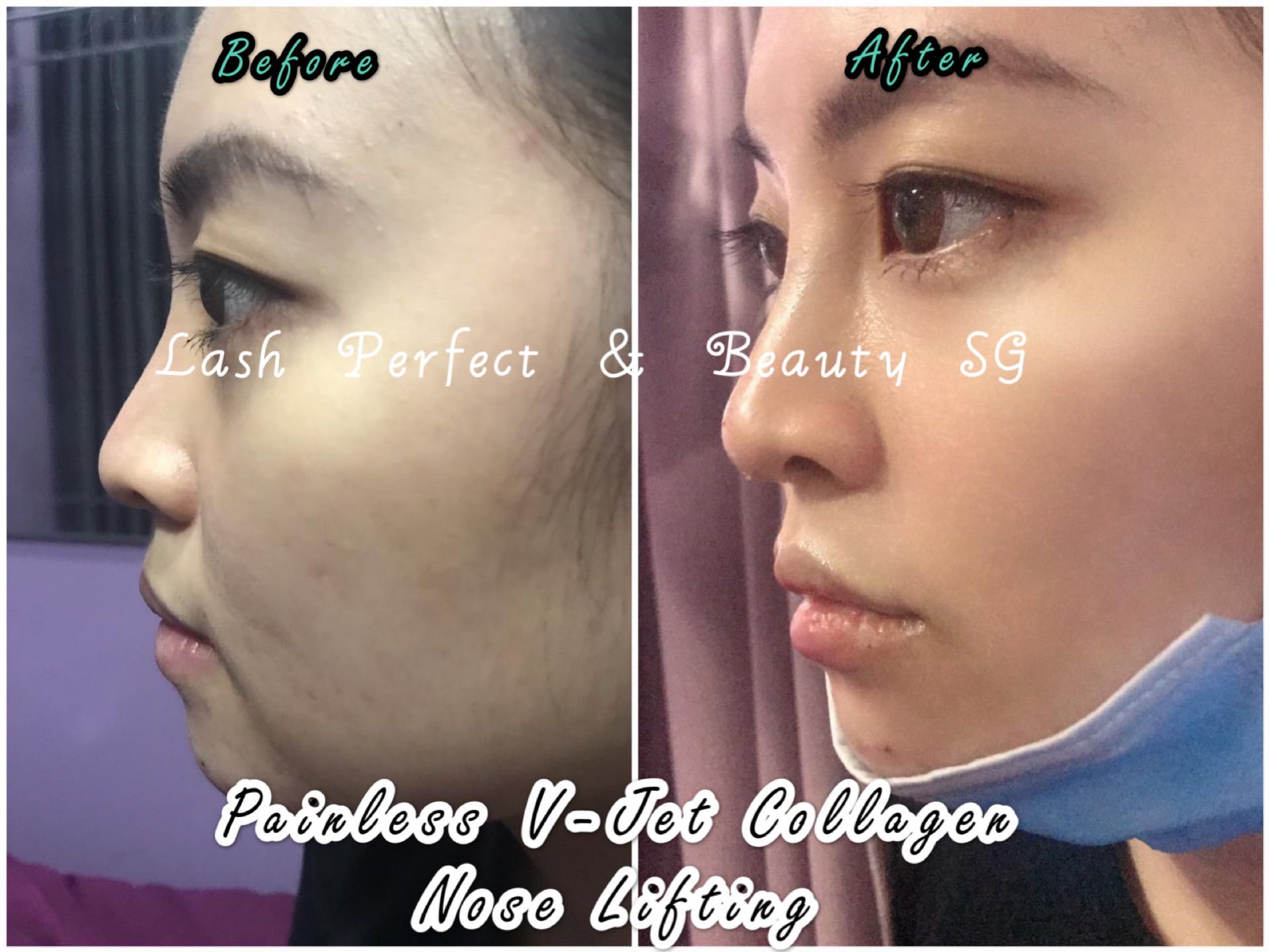 Nose Bridge, Nose Tips, Lips, Chin, Temple, Forehead, Under Eye ...