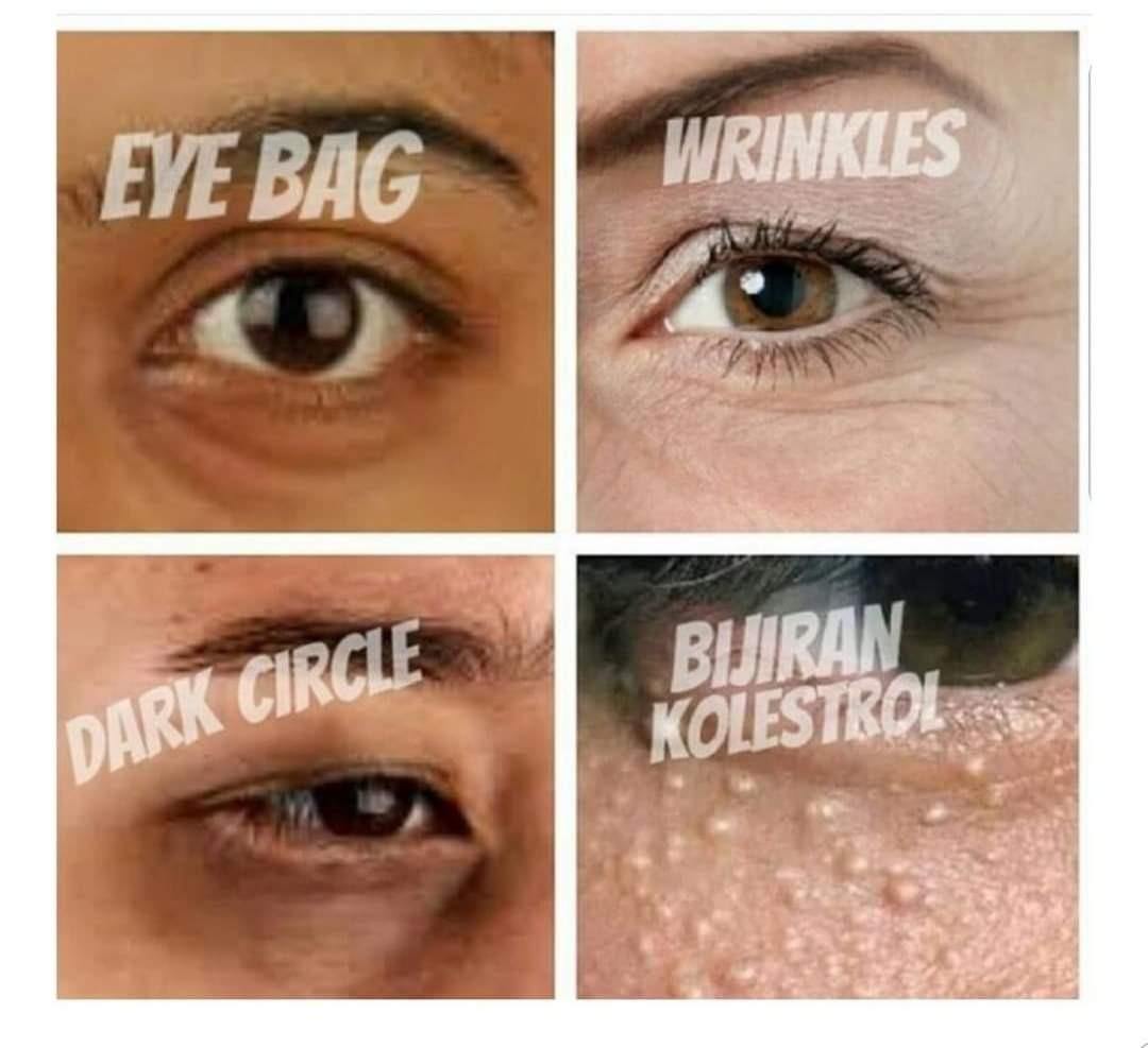 Susuk mata/Eye treatment, Beauty & Personal Care, Face, Face Care on ...