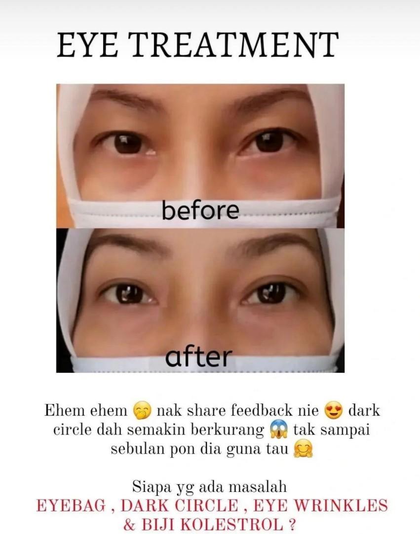 Susuk mata/Eye treatment, Beauty & Personal Care, Face, Face Care on ...