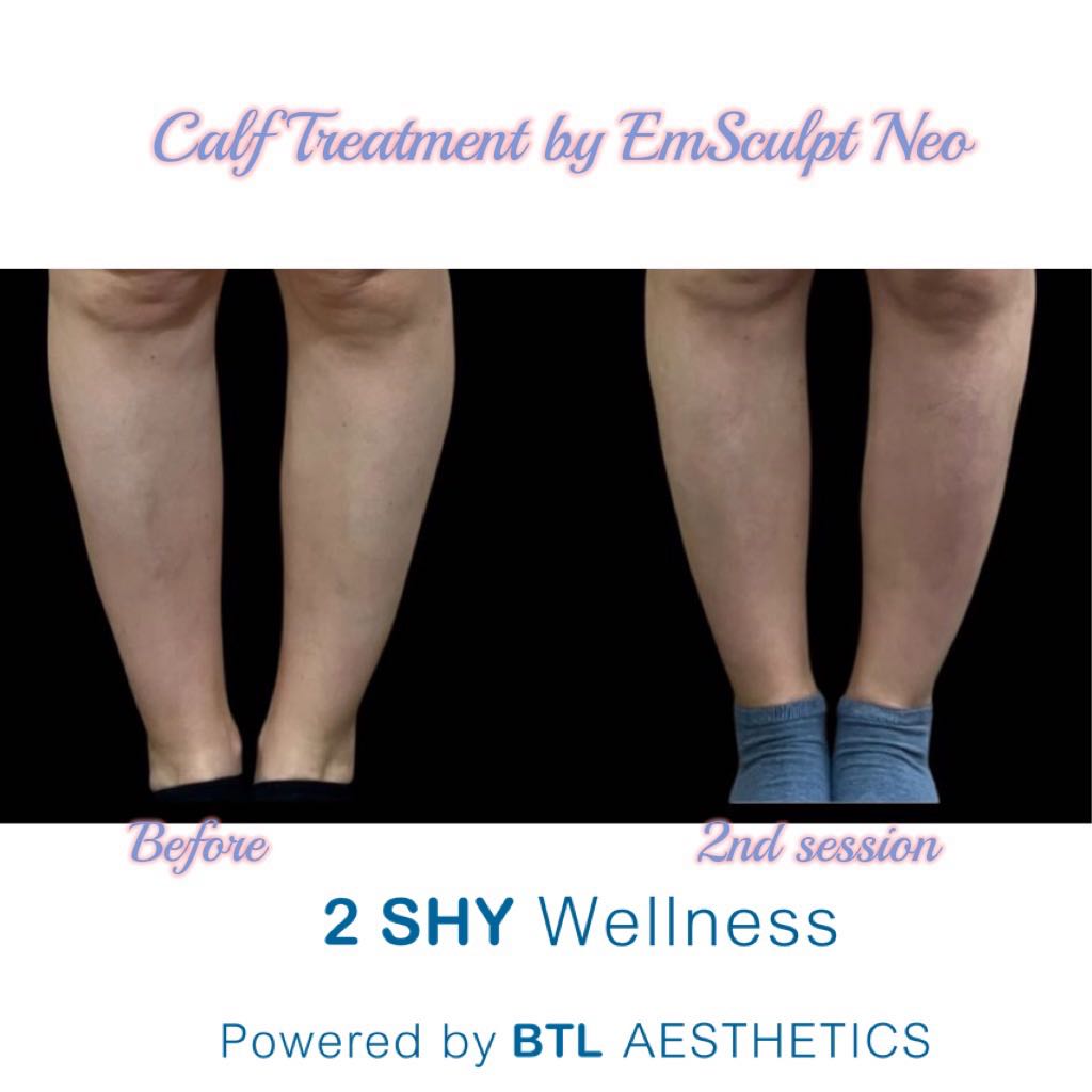 JAN Promo: Authentic EmSculpt Neo for calf / arms/inner thighs (FDA ...