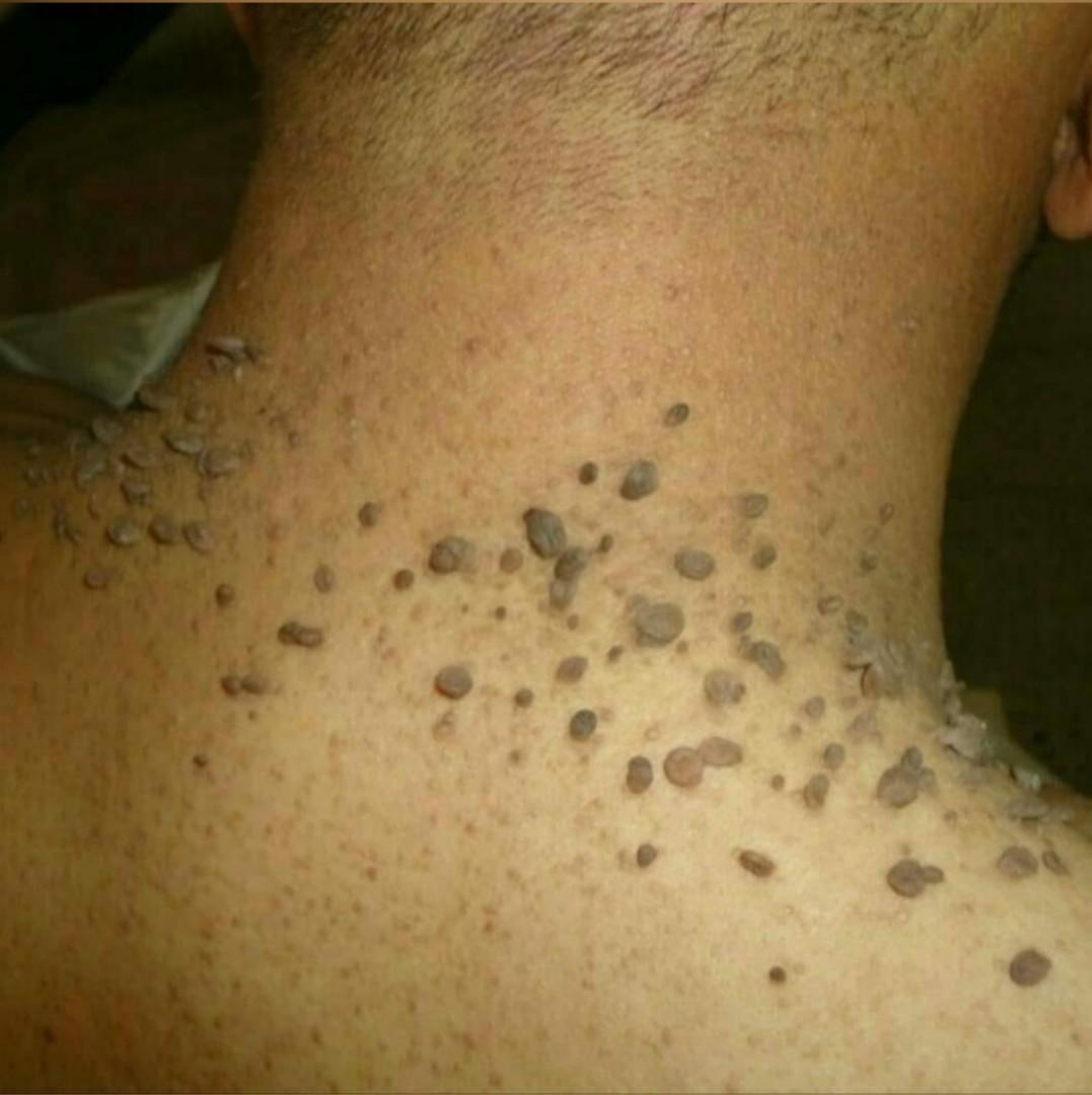 Millia Seed ,Skin Tag,Wart ,Syringoma,Tiny Bump,Oil Clog,Xanthelasma ...