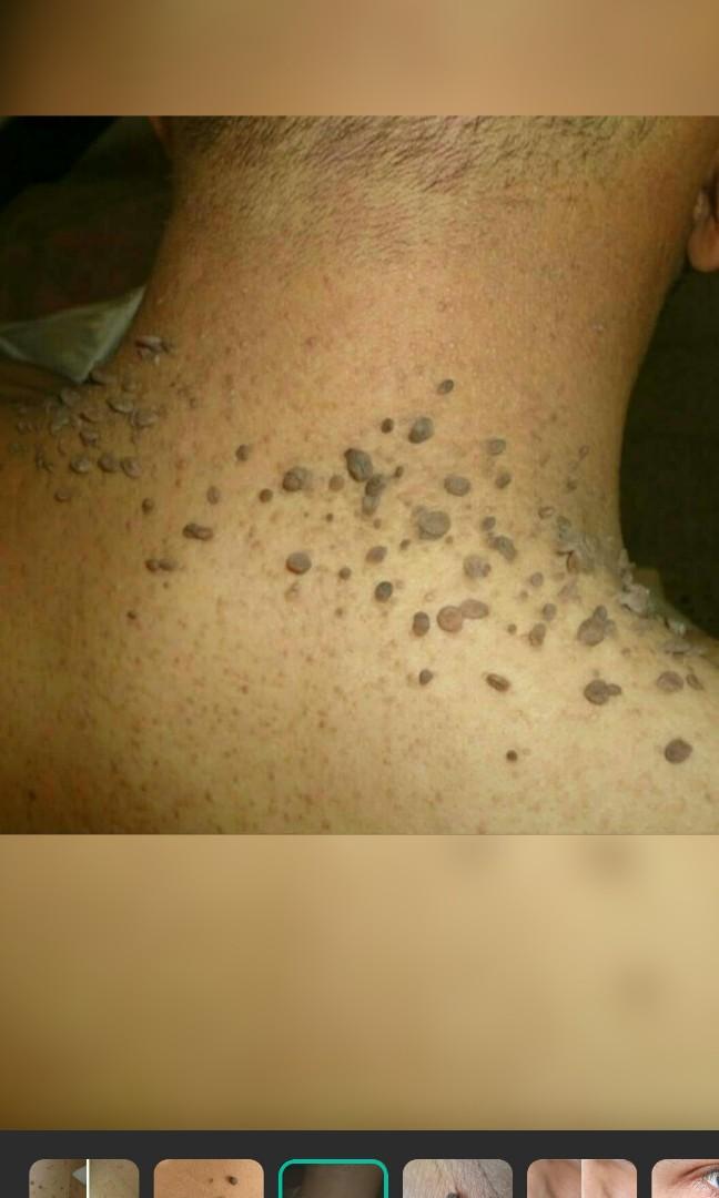 Millia Seed﻿,Skin Tag,Wart﻿,Syringoma,Tiny Bump,Oil Clog,Xanthelasma ...