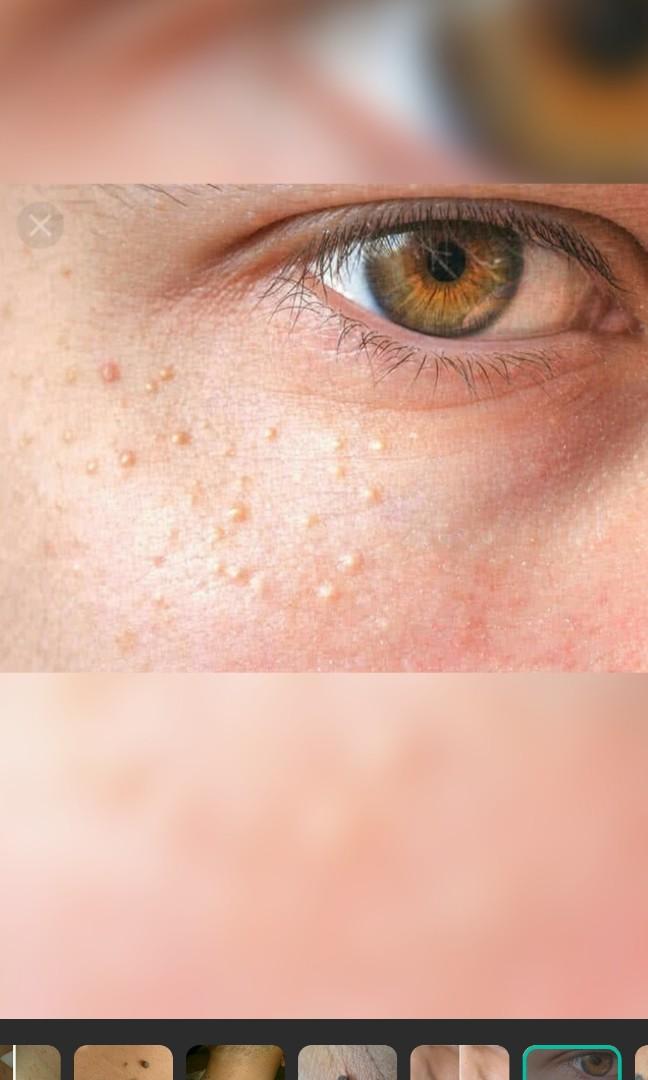 Millia Seed﻿,Skin Tag,Wart﻿,Syringoma,Tiny Bump,Oil Clog,Xanthelasma ...