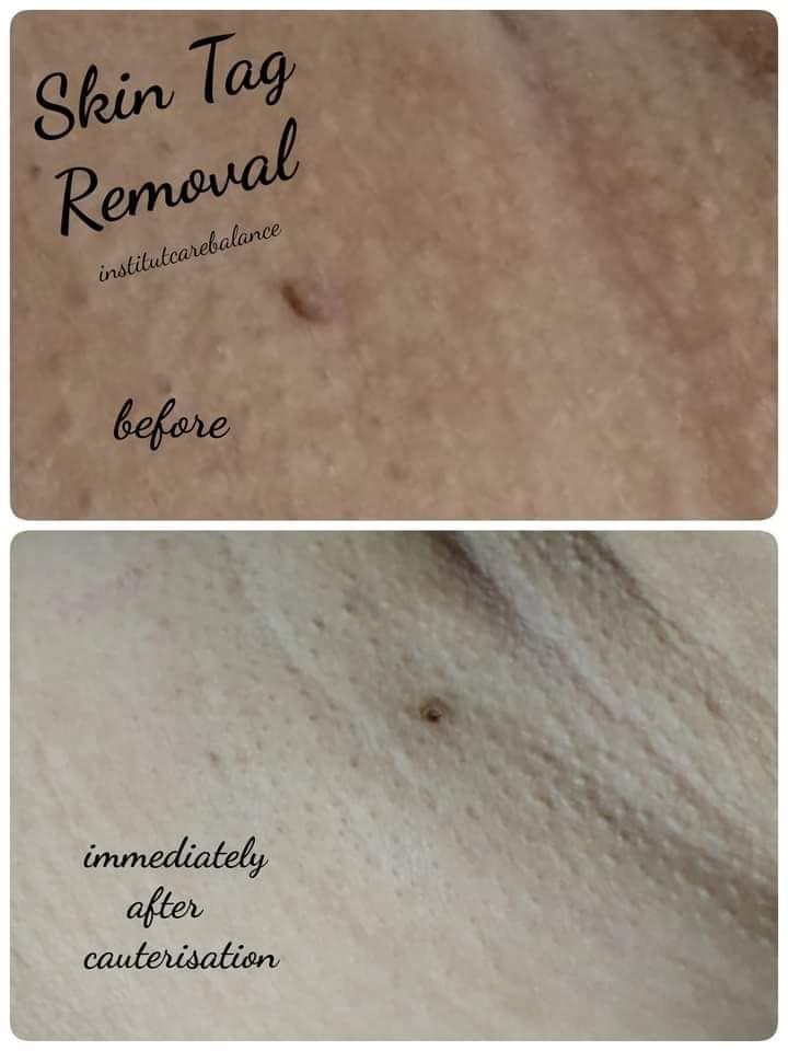 Milia Seed﻿,Skin Tag,Wart﻿,Syringoma,Tiny Bump,Oil Clog,Xanthelasma,Cholesterol, Mole﻿,Sebaceous ...