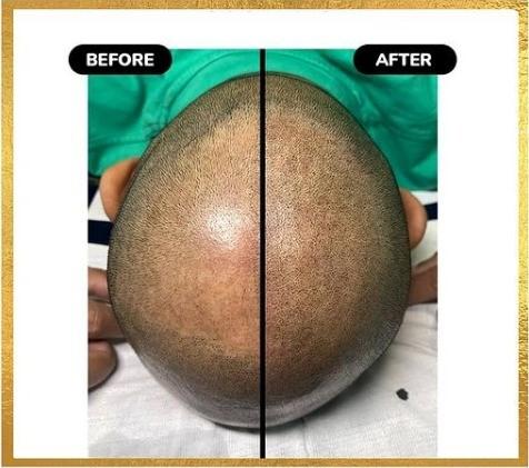 Beauty Recipe Scalp Micropigmentation & Hair tattoo (Male and/or Female ...