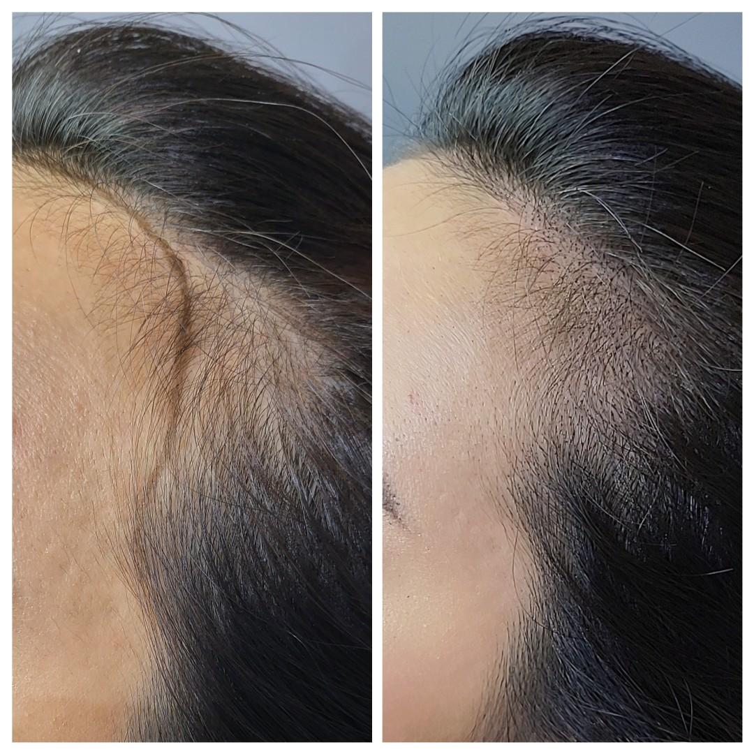 Beauty Recipe Scalp Micropigmentation & Hair tattoo (Male and/or Female ...