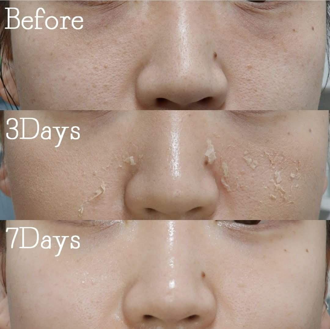 Non chemical peel with no acid 100% Natural Spicule Seanergy Peel ...