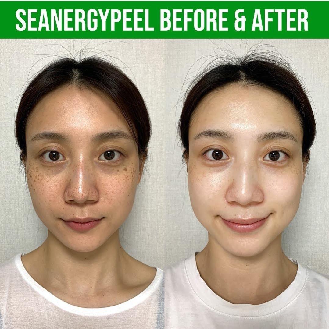 Non chemical peel with no acid 100% Natural Spicule Seanergy Peel ...