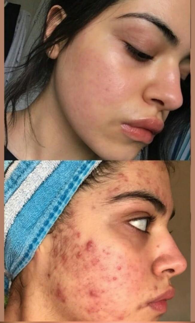 Pigmentation ,Age Spot, Freckles, Melasma,Lentigo,Sun Spot,Dark Spot ...