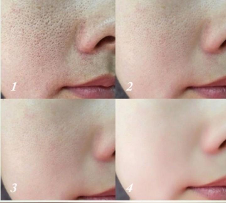 Pigmentation ,Age Spot, Freckles, Melasma,Lentigo,Sun Spot,Dark Spot ...