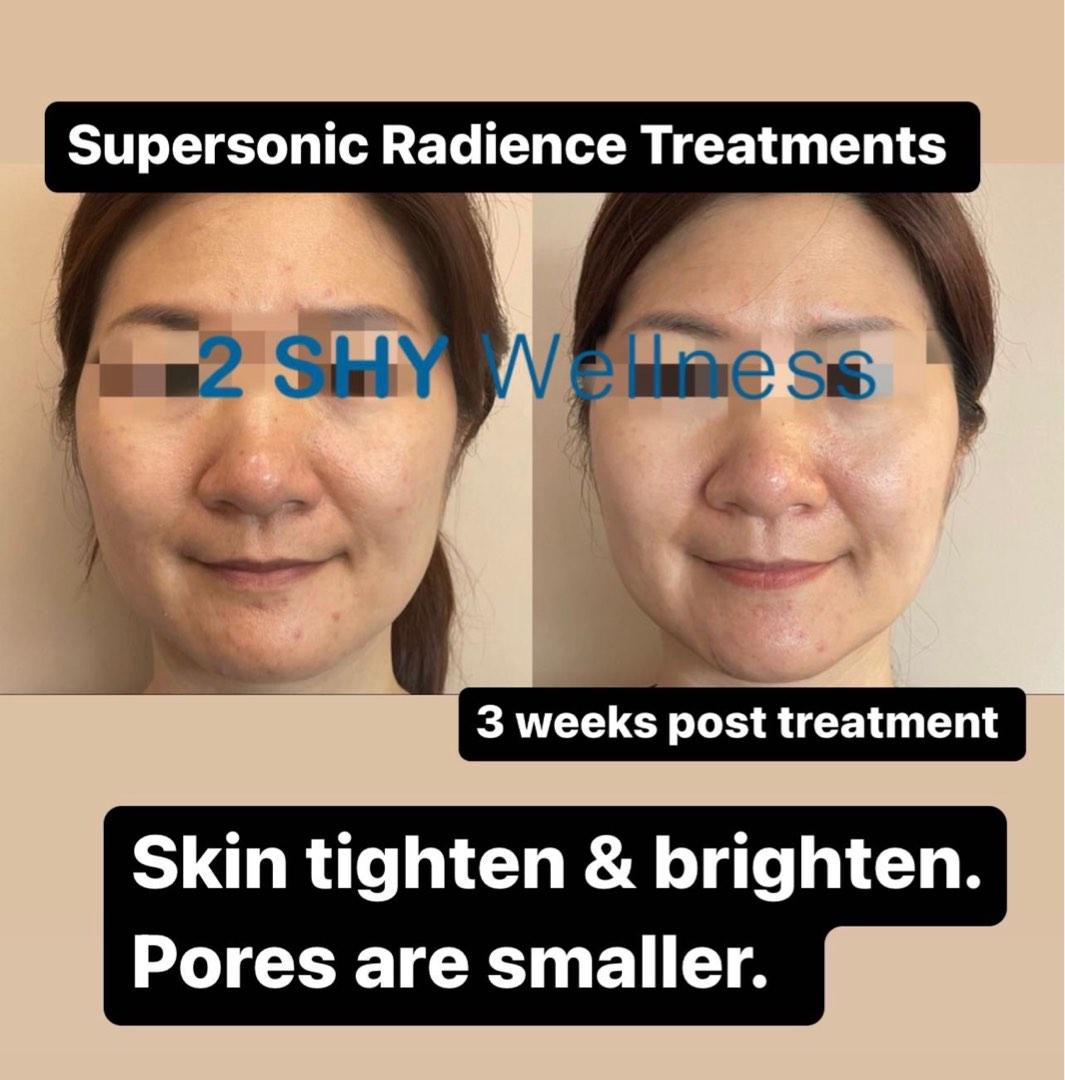 Hari Raya PROMO: All in one face treatment (acne, new scars, acne marks ...