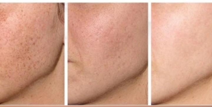Pigmentation ,Age Spot, Freckles, Melasma,Lentigo,Sun Spot,Dark Spot ...