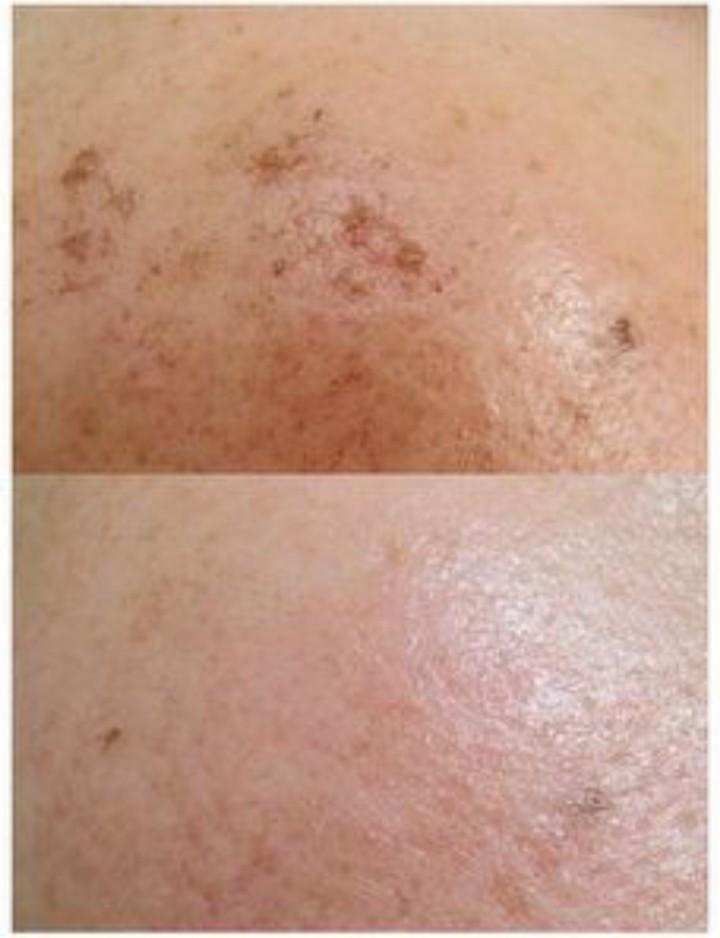 Pigmentation ,Age Spot, Freckles, Melasma,Lentigo,Sun Spot,Dark Spot ...