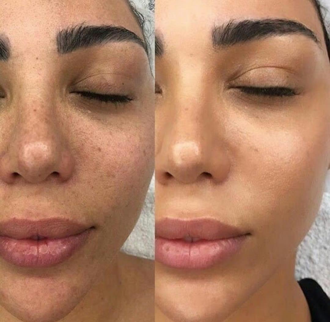 Pigmentation ,Age Spot, Freckles, Melasma,Lentigo,Sun Spot,Dark Spot ...