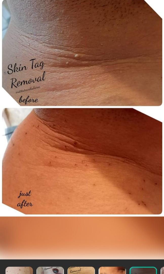 Milia Seed﻿,Skin Tag,Wart﻿,Syringoma,Tiny Bump,Oil Clog,Xanthelasma ...