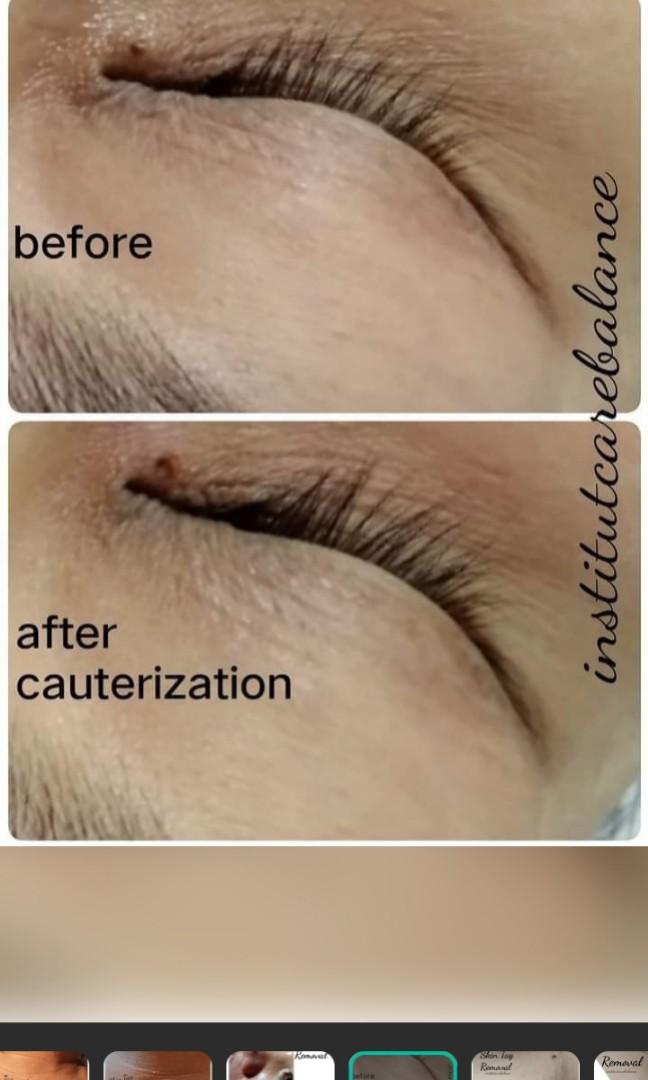 Milia Seed﻿,Skin Tag,Wart﻿,Syringoma,Tiny Bump,Oil Clog,Xanthelasma ...