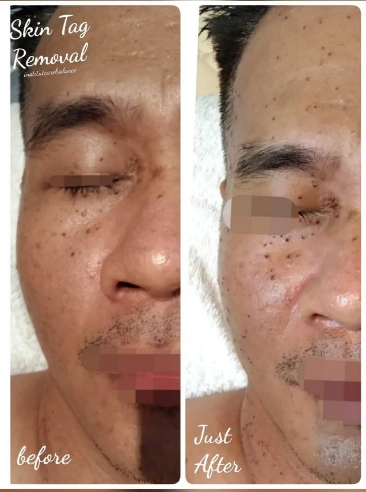 Milia Seed﻿,Skin Tag,Wart﻿,Syringoma,Tiny Bump,Oil Clog,Xanthelasma ...