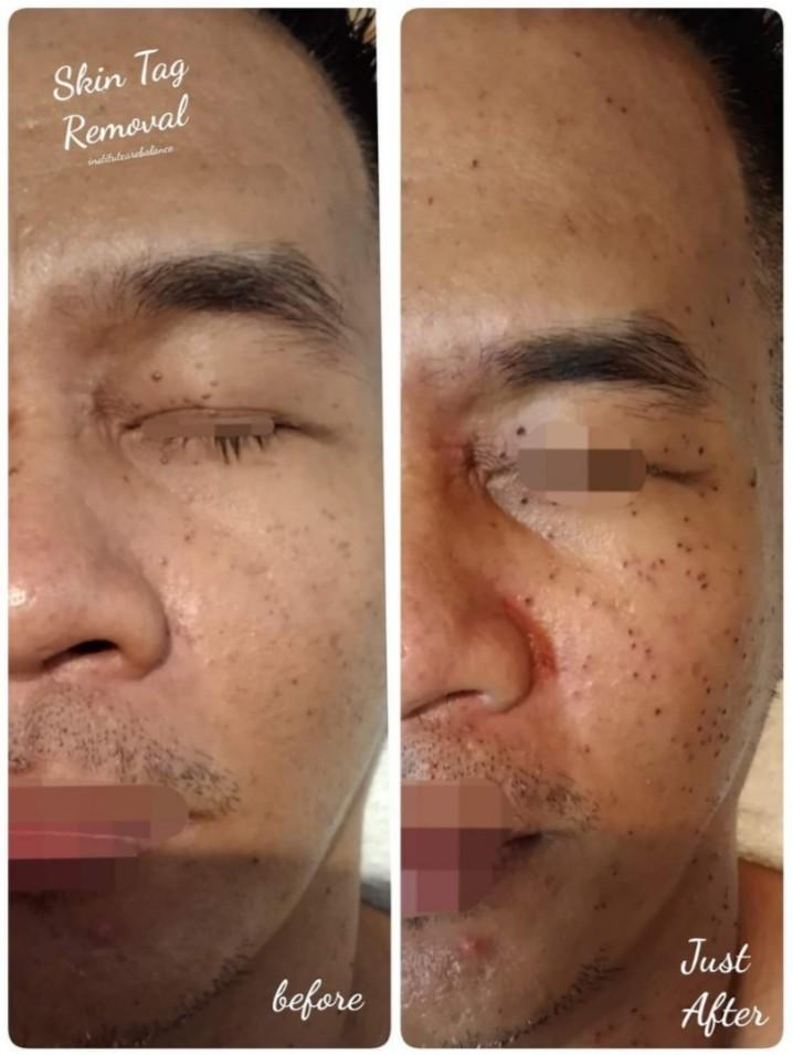 Milia Seed﻿,Skin Tag,Wart﻿,Syringoma,Tiny Bump,Oil Clog,Xanthelasma,Cholesterol, Mole﻿,Sebaceous ...