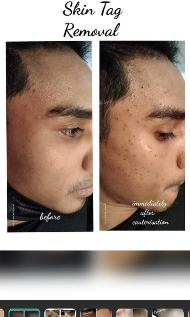 Milia Seed﻿,Skin Tag,Wart﻿,Syringoma,Tiny Bump,Oil Clog,Xanthelasma ...