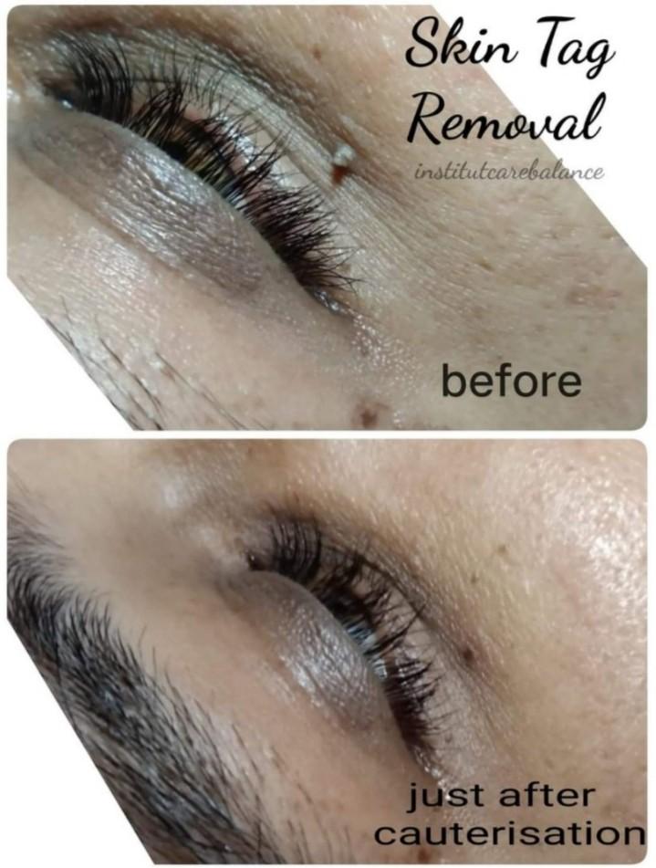 Milia Seed﻿,Skin Tag,Wart﻿,Syringoma,Tiny Bump,Oil Clog,Xanthelasma ...