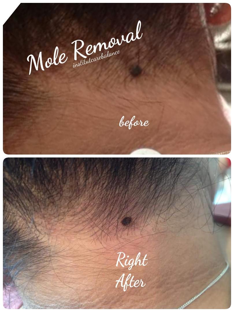 Milia Seed﻿,Skin Tag,Wart﻿,Syringoma,Tiny Bump,Oil Clog,Xanthelasma,Cholesterol, Mole﻿,Sebaceous ...