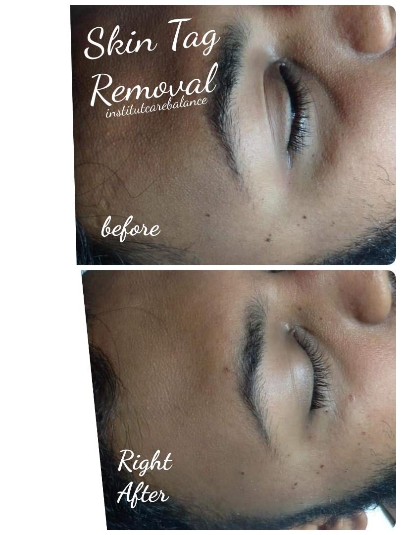 Milia Seed﻿,Skin Tag,Wart﻿,Syringoma,Tiny Bump,Oil Clog,Xanthelasma ...