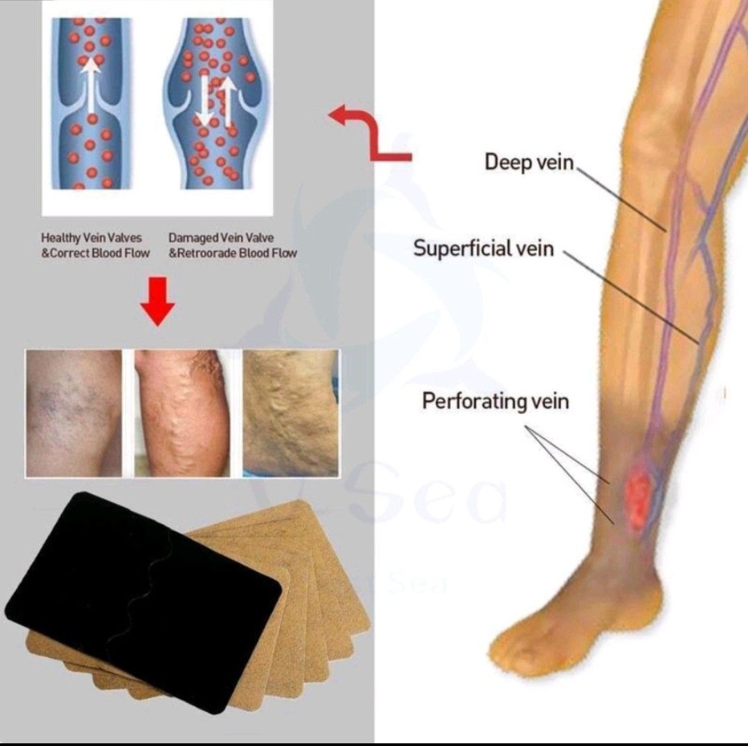 Varicose Veins Plaster, Beauty & Personal Care, Foot Care on Carousell