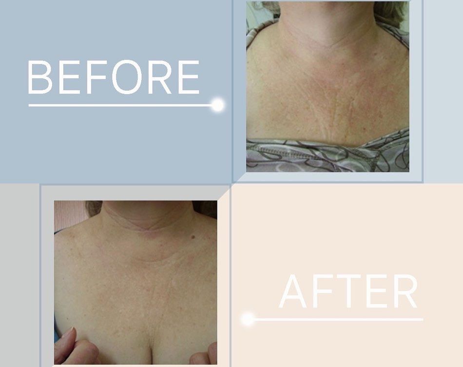 以色列製 #Forma Light 脈衝光（intense pulsed light, IPL）, 美容＆化妝品, 健康及美容 - 皮膚護理 ...