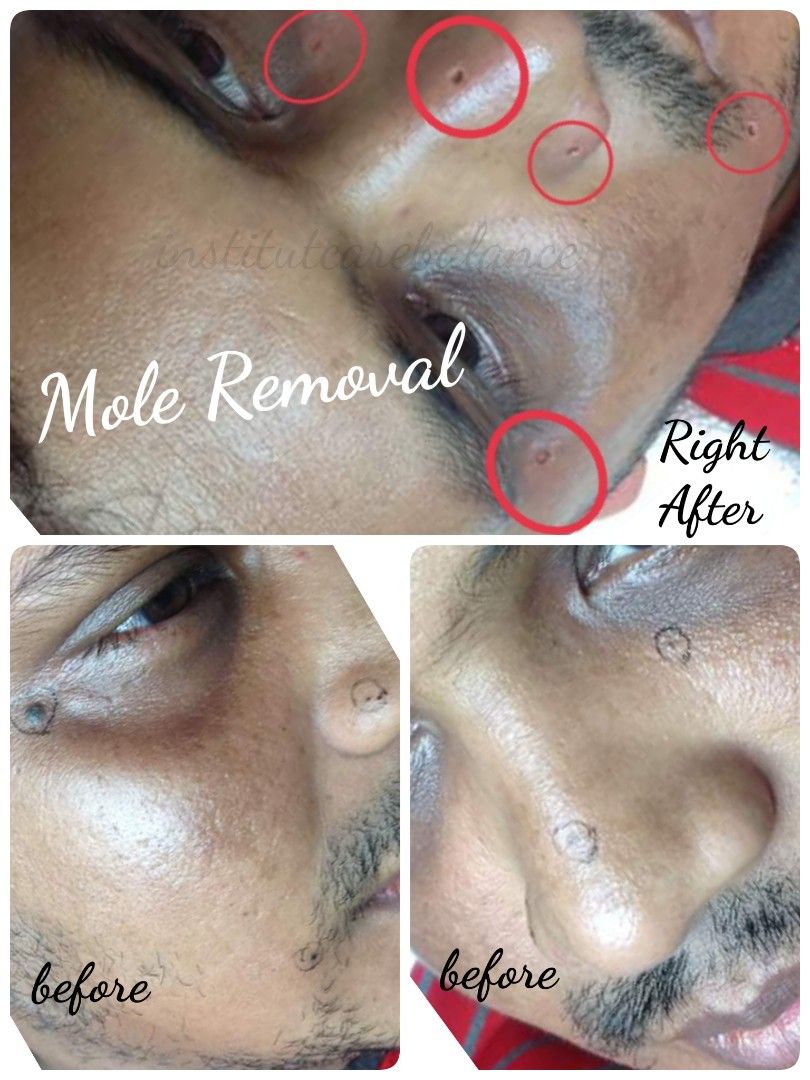 Milia Seed﻿,Skin Tag,Wart﻿,Syringoma,Tiny Bump,Oil Clog,Xanthelasma,Cholesterol, Mole﻿,Sebaceous ...